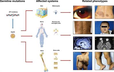 Frontiers | Impacts of NF1 Gene Mutations and Genetic Modifiers in Neurofibromatosis Type 1